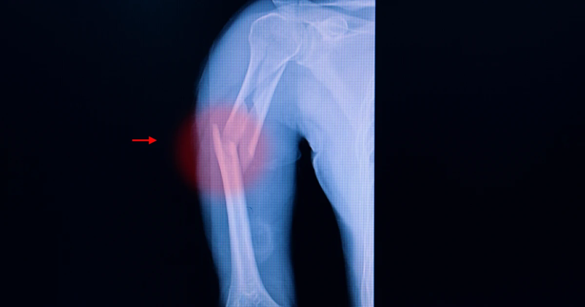 Prelom nadlaktice - Oporavak i Vežbe - Sucevic.rs