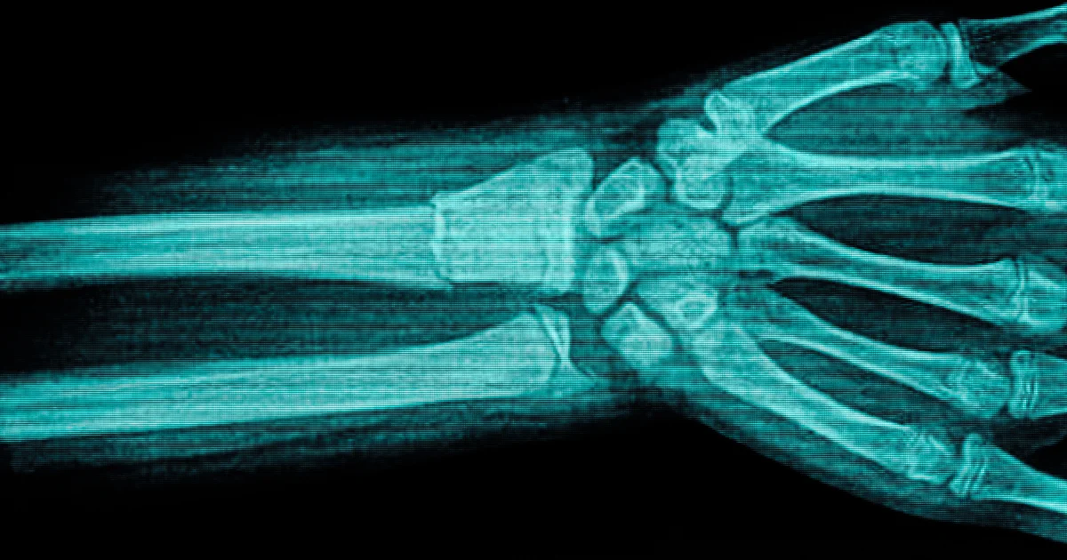 Prelom ručnog zgloba - Sucevic.rs